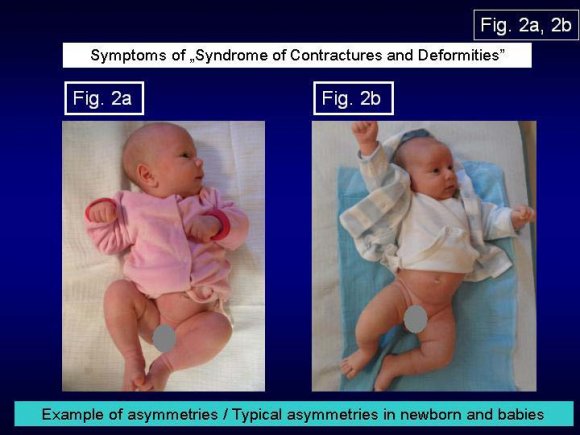Biomechanical Aetiology of the So-Called Idiopathic Scoliosis. New ...