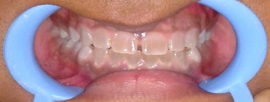 Dentinogenesis Imperfecta Type II-A Case Report with Review of Literature