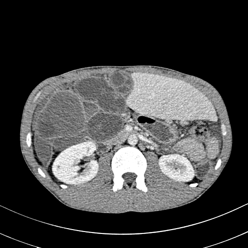 Acute Generalized Peritonitis due to Peritoneal Hydatid Cyst Rupture