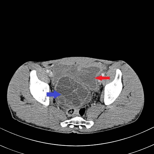 Acute Generalized Peritonitis due to Peritoneal Hydatid Cyst Rupture