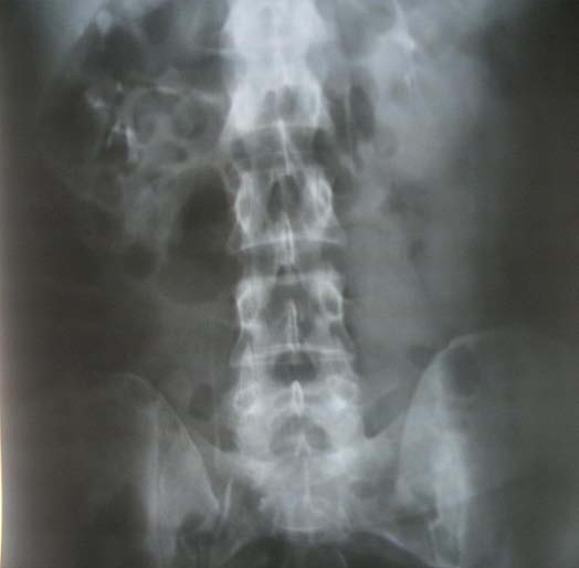 Figure A : Fond d'oeil gauche montrant les nodules de Dalen-fuchs avec ...