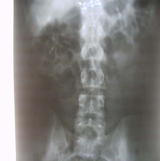Figure A : Fond d'oeil gauche montrant les nodules de Dalen-fuchs avec ...