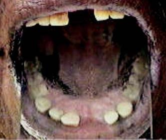 Malocclusion, Phonetics & Palatography: The Link Express