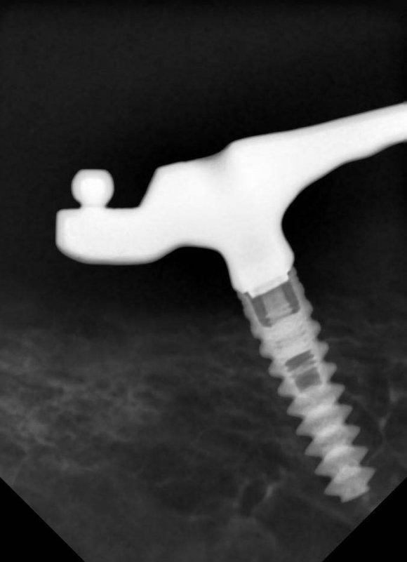 Prosthetic Rehabilitation of a Patient with Alzheimers Disease using a ...