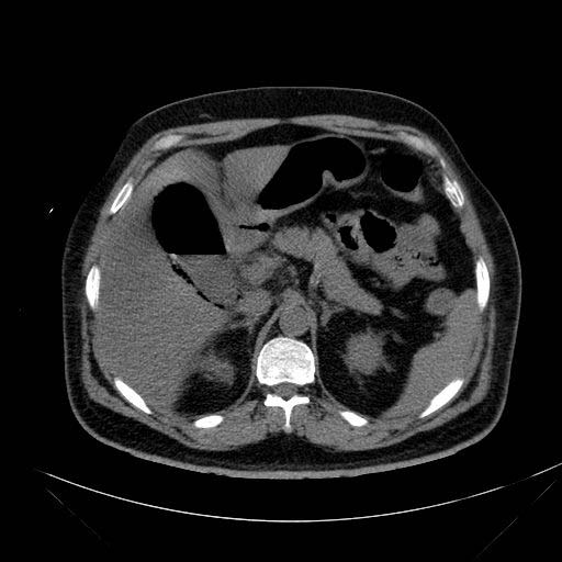 Emphysematous Cholecystitis: A Case Successfully Treated with ...