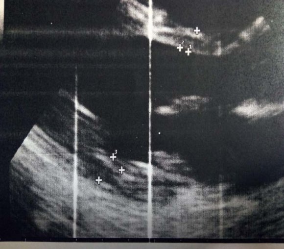 Prognosis of Urinary Bladder TCC in Young Adults: A Single Center ...