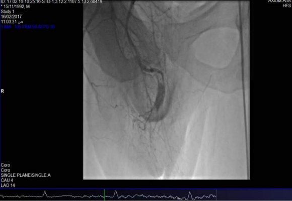 High-Flow Priapism following Chlorpromazine Induced Low-Flow Priapism