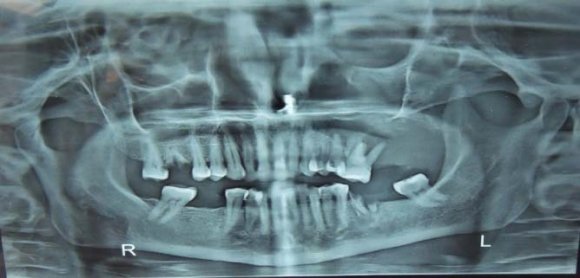 Adenocarcinoma of Left Maxilla: Case Report (Clinico Radiologic ...