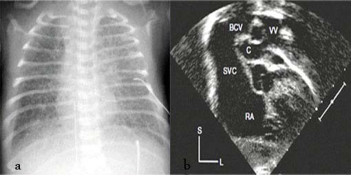 Pulmonary Venous Connection (Sarmast-Takriti Shunt)