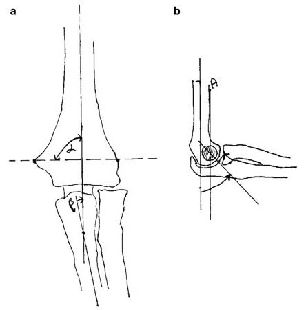 Outcomes of Lateral Column Plating in Extra-Articular Distal Humerus ...