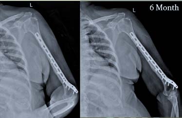 Outcomes of Lateral Column Plating in Extra-Articular Distal Humerus ...