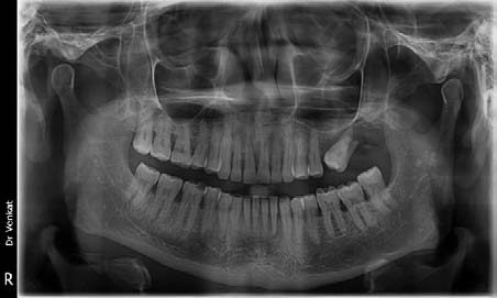 Pterygoid Implant: A Graftless Approach for Maxillary Rehabilitation ...