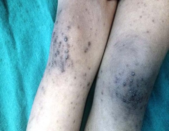 Murray-Jackson-Lawler Syndrome