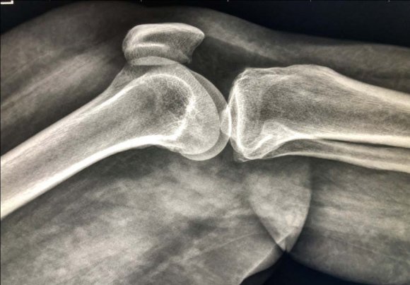 Chronic Dislocation of the 5 th Metatarsophalangeal Joint with Physeal ...