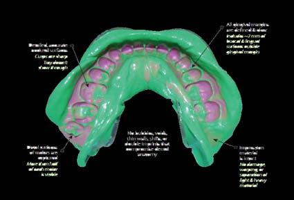 A Case Report of Comminuted Mandibular Fracture with Condylar Neck Fracture