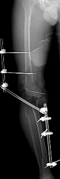 Management of Grade 3C Compound Injury of Right Lower Limb with ...