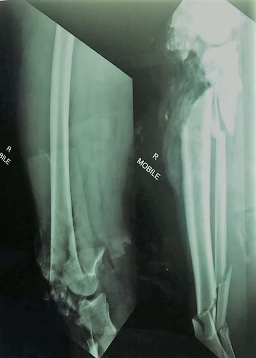 Management of Grade 3C Compound Injury of Right Lower Limb with ...