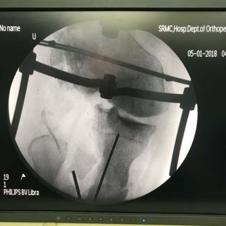 Management of Grade 3C Compound Injury of Right Lower Limb with ...