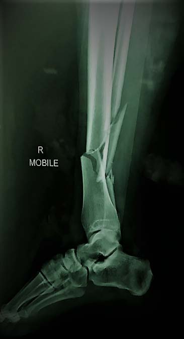 Management of Grade 3C Compound Injury of Right Lower Limb with ...