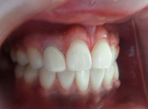 Management of Internal Root Resorption A-Case Series