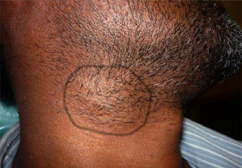 Submandibular Cervical Mass as the First Presenting Sign of FVPTC. A ...