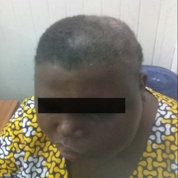 Sturge-Weber Syndrome in a 28-Year-old Tanzanian Female: A Case Report