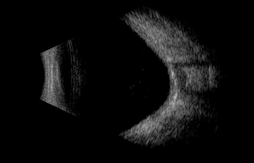 Cataract Surgery in Highly Myopic Eyes