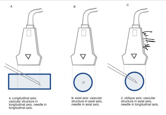 Ultrasound-Guided Central Venous Catheterization. Study Guide