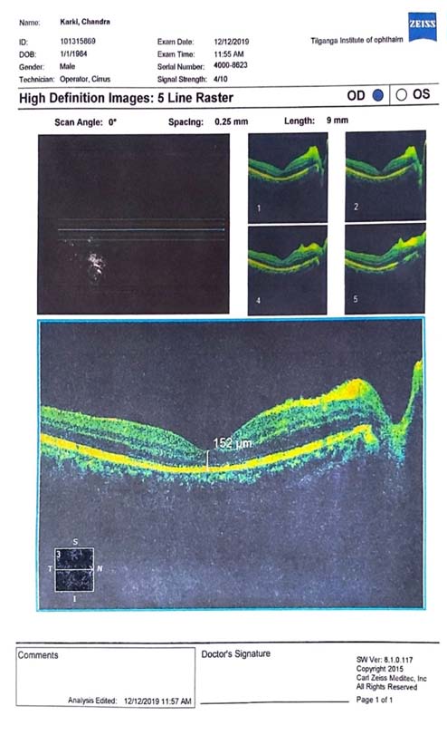 A Rare Case of Purtscher's Retinopathy Seen in RTA Patient