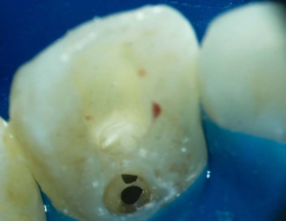 Comprehensive Diagnosis of an Invaginated Tooth Prior to Endodontic ...