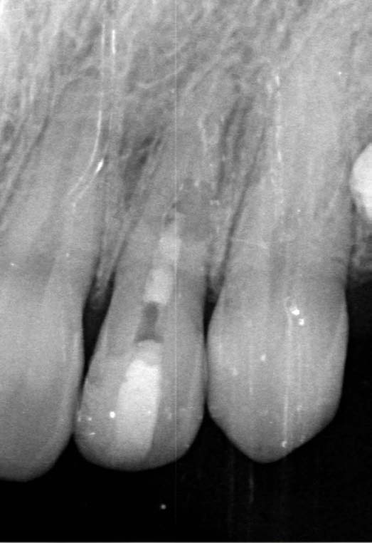 Comprehensive Diagnosis of an Invaginated Tooth Prior to Endodontic ...