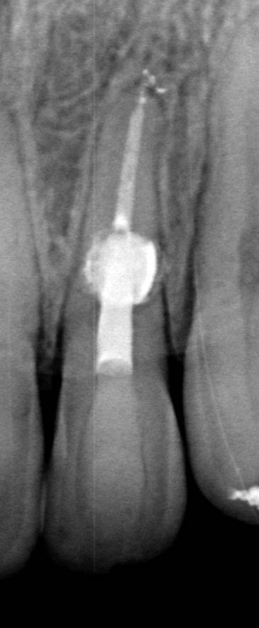 Comprehensive Diagnosis of an Invaginated Tooth Prior to Endodontic ...