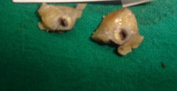 Atherosclerosis of Coronary Arteries -An Autopsy Study