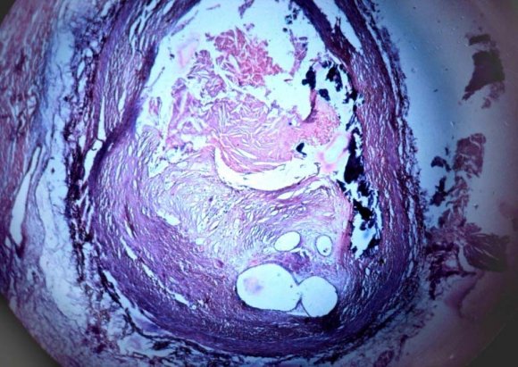 Atherosclerosis of Coronary Arteries -An Autopsy Study