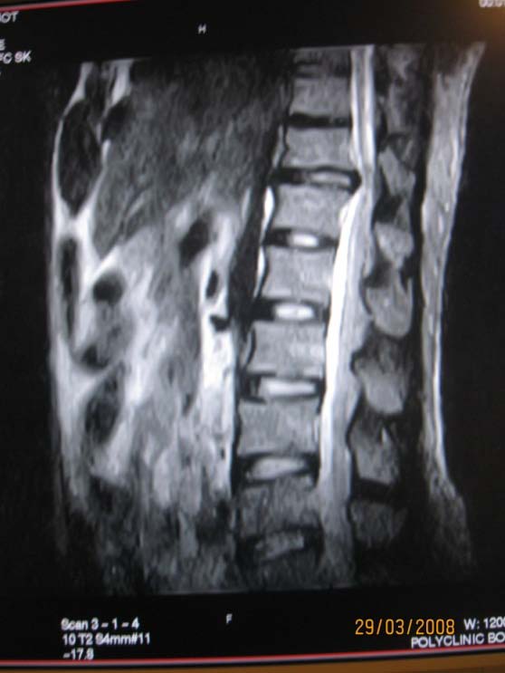 Evaluation of Pattern of Magnetic Resonance Images of Lumbo-Sacral ...