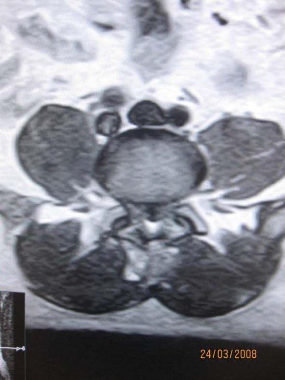 Evaluation of Pattern of Magnetic Resonance Images of Lumbo-Sacral ...