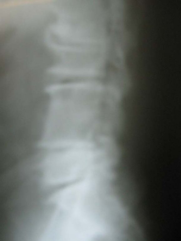 Evaluation of Pattern of Magnetic Resonance Images of Lumbo-Sacral ...