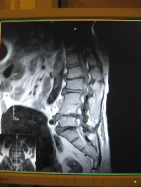 Evaluation of Pattern of Magnetic Resonance Images of Lumbo-Sacral ...