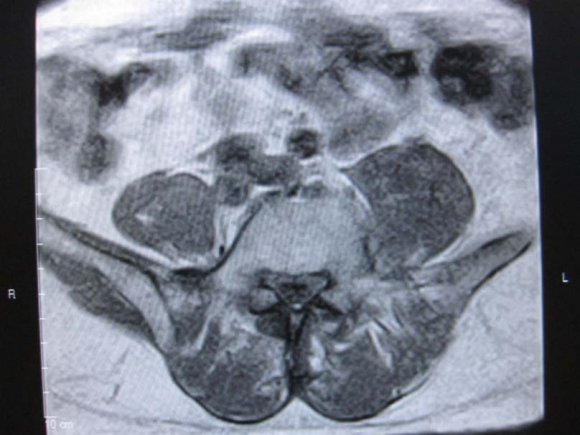 Uncommon Types of Disc Hernia (A Report of Three Cases and Review of ...