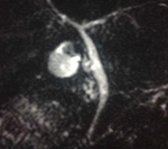 Symptomatic Cystic Duct Stump Lithiasis 21Years after Cholecystectomy